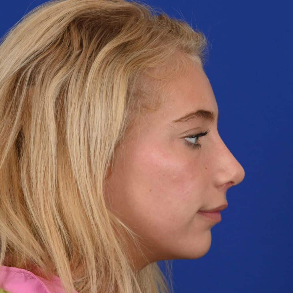 Causes of Flared Nostrils After a Rhinoplasty - Houston Facial Surgeon ...