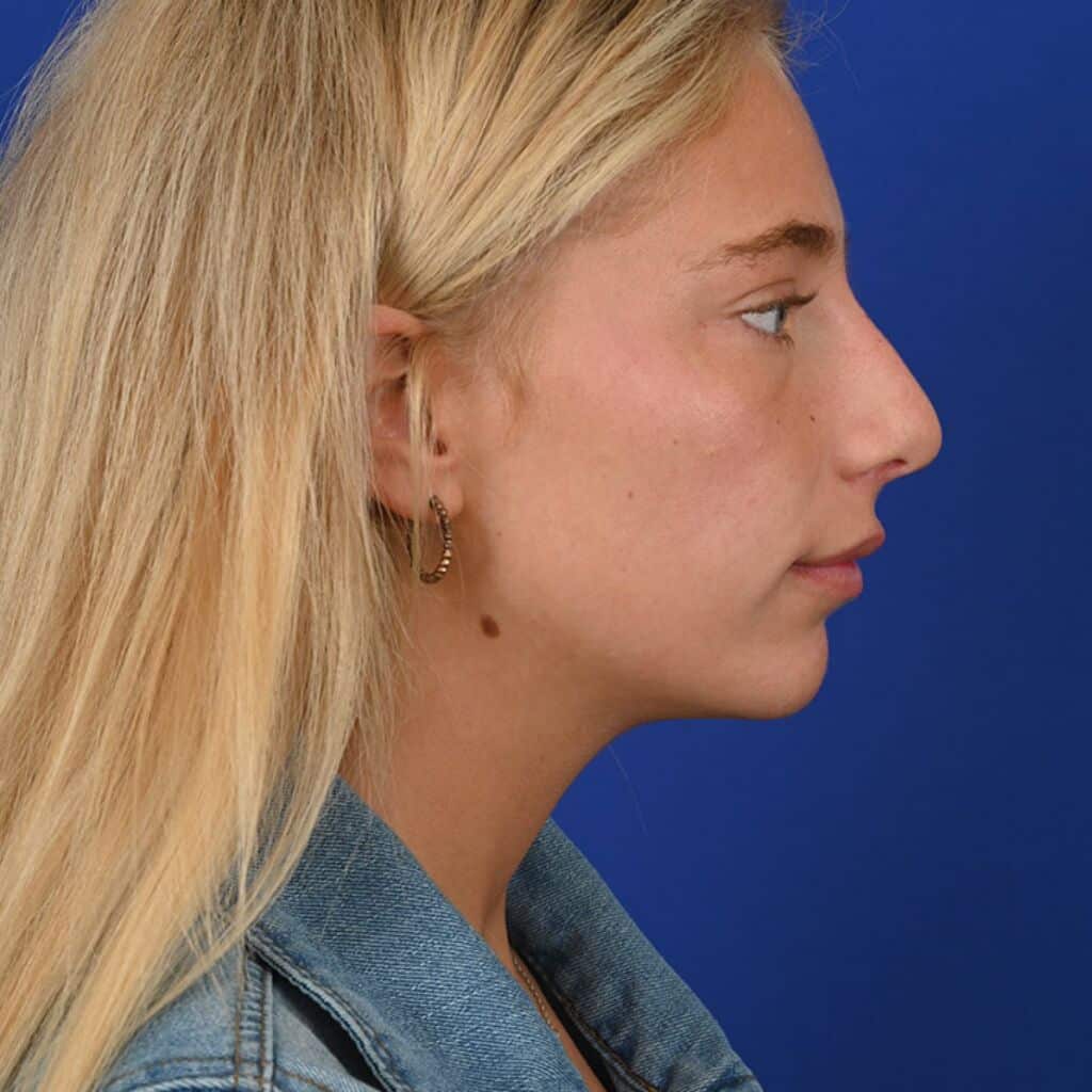 Causes of Flared Nostrils After a Rhinoplasty - Houston Facial Surgeon ...