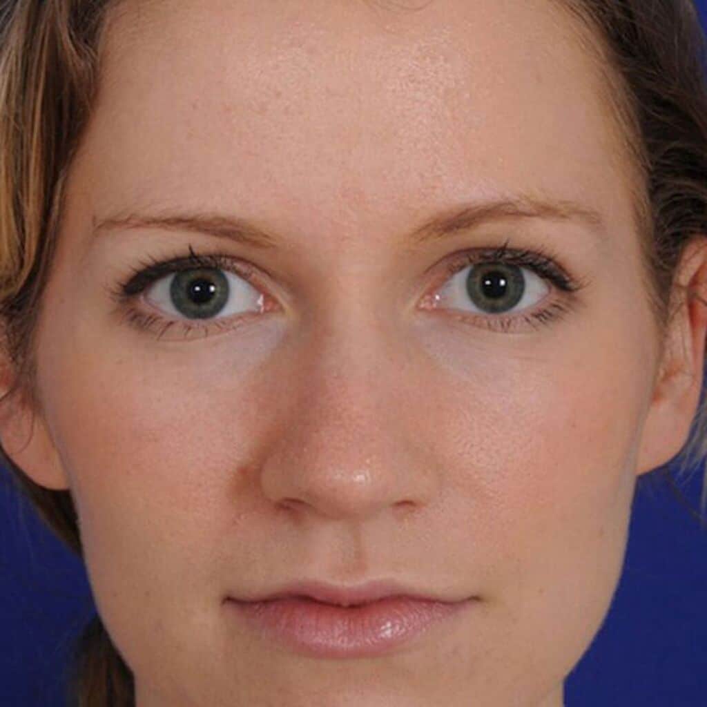 Causes of Flared Nostrils After a Rhinoplasty - Houston Facial Surgeon ...
