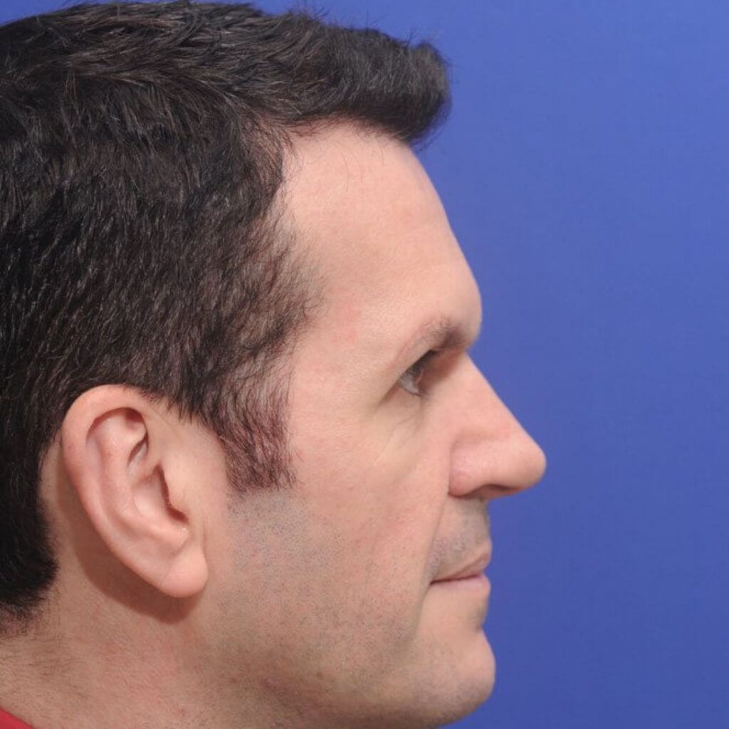 Causes of Flared Nostrils After a Rhinoplasty - Houston Facial Surgeon ...